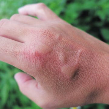 What Bit You? Australian Insect Bites Identification