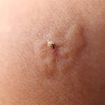 What Bit You? Australian Insect Bites Identification