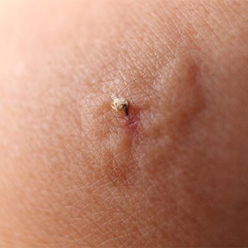 What Bit You? Australian Insect Bites Identification