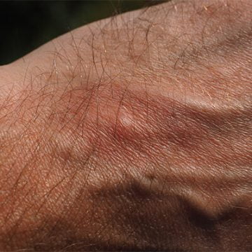 What Bit You? Australian Insect Bites Identification