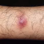 What Bit You? Australian Insect Bites Identification